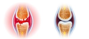 Knee Active Plus Test? ++Echte Erfahrungen zum Kauf | Gnadenlos ehrlich ...